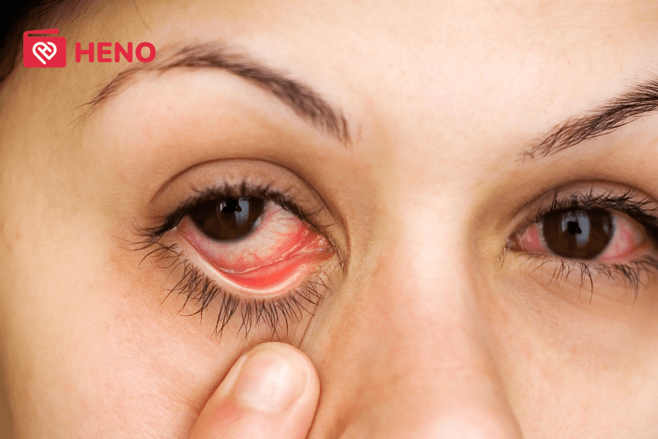 Bệnh đau mắt đỏ và những điều bạn cần biết để nhanh chóng khỏi bệnh