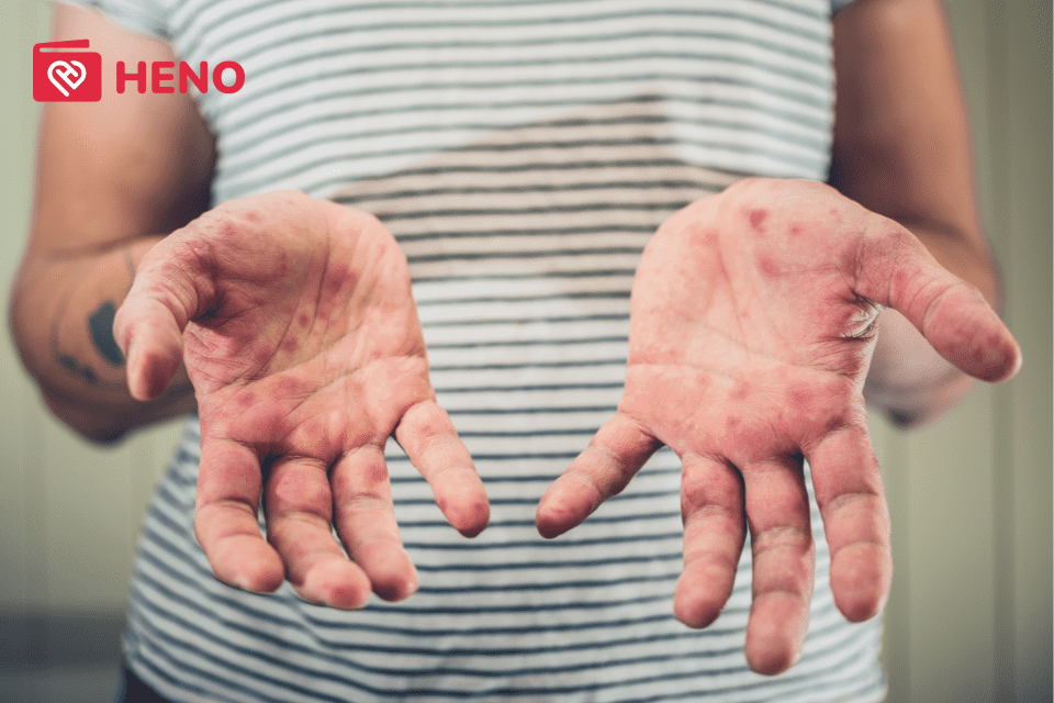 Sốt phát ban dạng sởi: Dấu hiệu nhận biết và những điều cần lưu ý